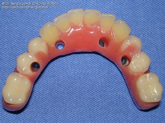 Prótese Protocolo Inferior e Prótese Total Removível Superior, Caso ...