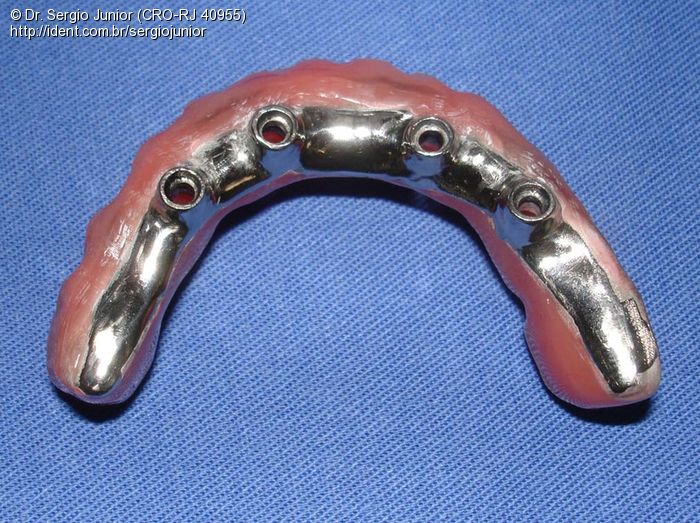 Prótese Protocolo Inferior e Prótese Total Removível Superior, Caso ...