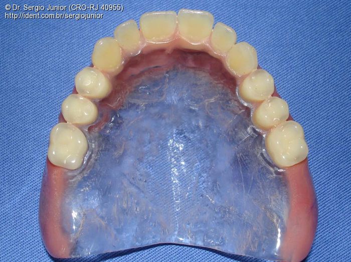 Prótese Protocolo Inferior e Prótese Total Removível Superior, Caso ...