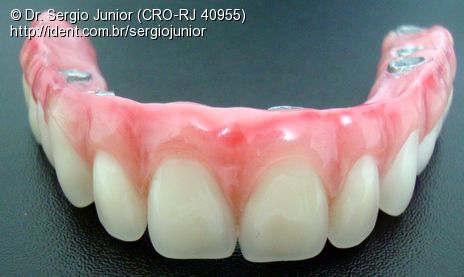 Protocolo Superior - Fase Prótese, Caso clínico | iDent