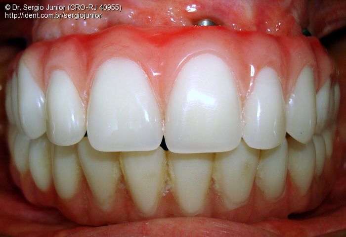 Protocolo Superior - Fase Prótese, Caso clínico | iDent