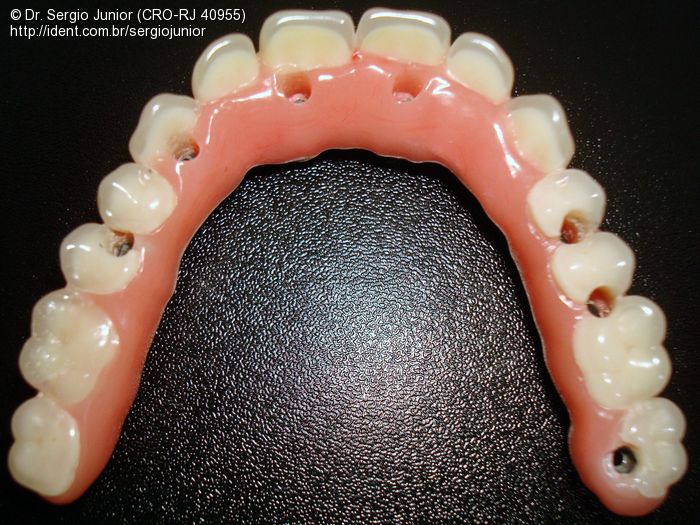 Protocolo Superior - Fase Prótese, Caso clínico | iDent