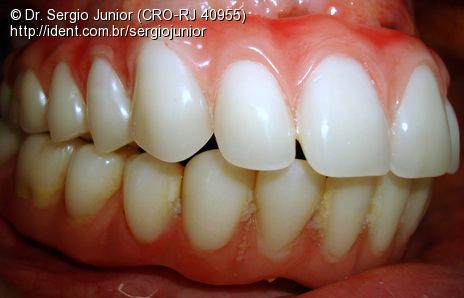 Protocolo Superior - Fase Prótese, Caso clínico | iDent