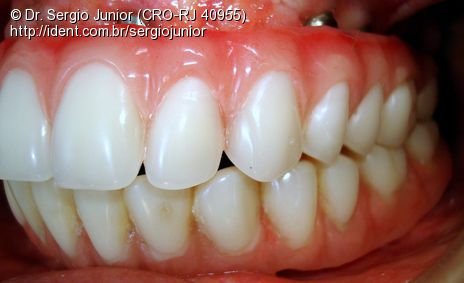 Protocolo Superior - Fase Prótese, Caso clínico | iDent