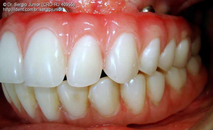 Protocolo Superior - Fase Prótese, Caso clínico | iDent