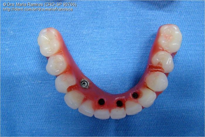 Realização de Prótese Tipo Protocolo Inferior e Prótese Total Superior ...