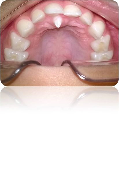 Dente Supranumerário( Mesiodente ), Caso clínico | iDent