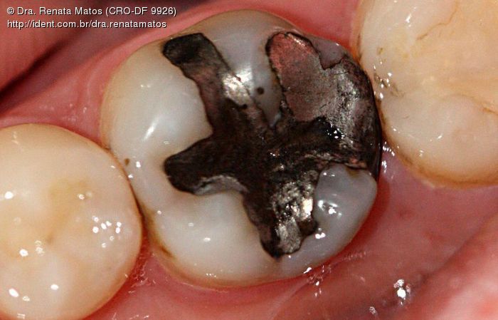 Restauração Indireta do Tipo Onlay em E. Max Press, Caso clínico | iDent