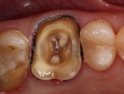 Endocrown, Caso clínico | iDent