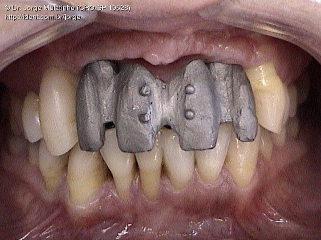 Protese Fixa de 4 Elementos Parafusada Sobre 2 Implantes, Caso clínico ...