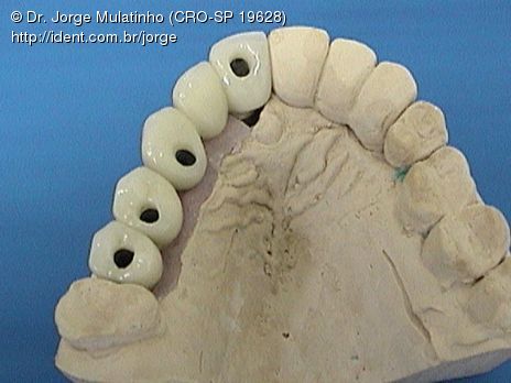 Proteses Fixas Cimentadas e Parafusadas, Caso clínico | iDent