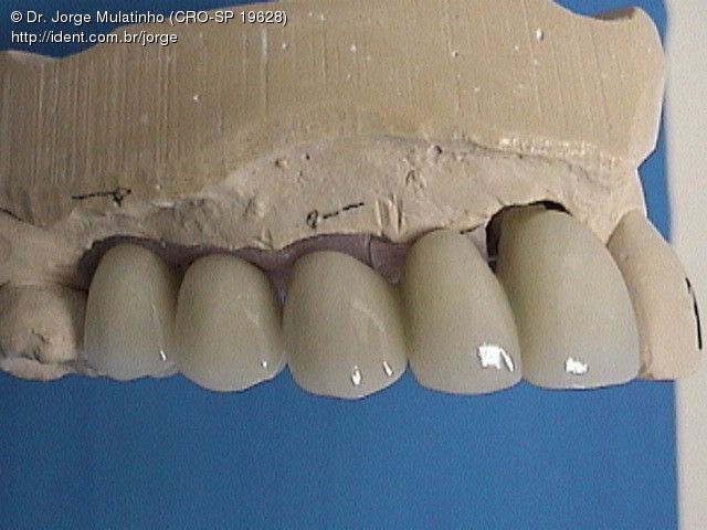 Proteses Fixas Cimentadas e Parafusadas, Caso clínico | iDent