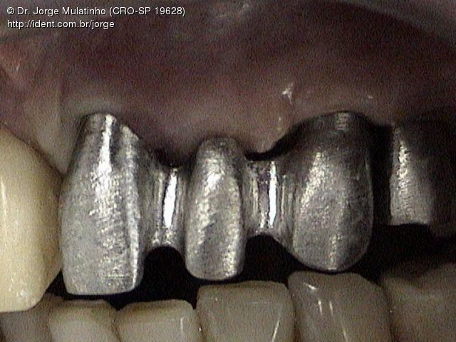 Proteses Fixas Cimentadas e Parafusadas, Caso clínico | iDent