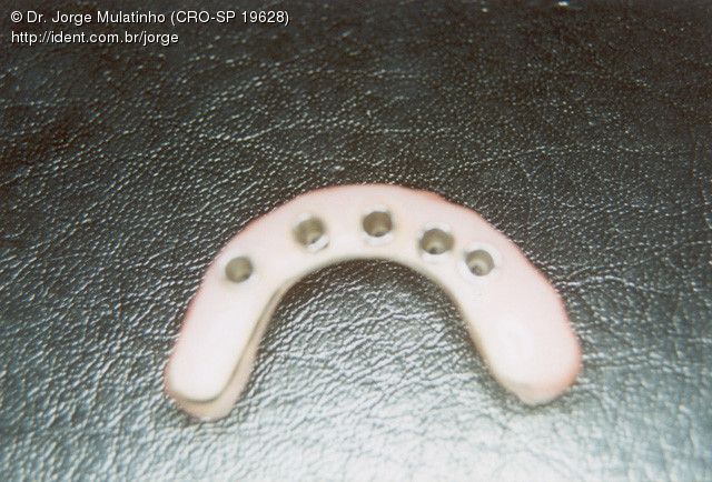 Protocolo de Branemark, Caso clínico | iDent