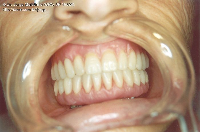 Protocolo de Branemark, Caso clínico | iDent