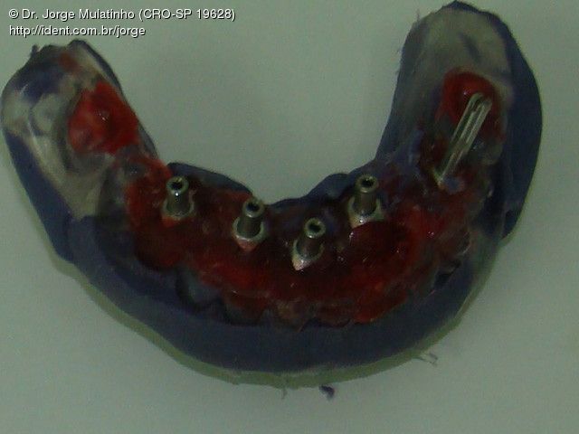 Protocolo com Função Imediata Utilizando Implantes de Corpo Único, Caso ...