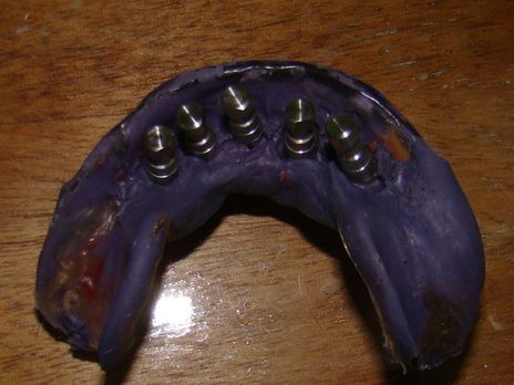 Protocolo com Função Imediata Utilizando Implantes de Corpo Único, Caso ...
