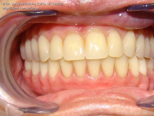 Protocolo com Função Imediata Utilizando Implantes de Corpo Único, Caso ...