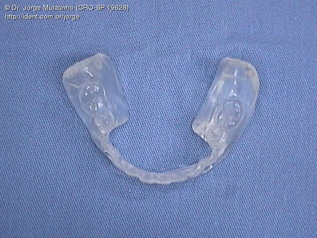 Protocolo com Função Imediata Utilizando Implantes de Corpo Único, Caso ...