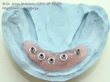 Protocolo com Função Imediata Utilizando Implantes de Corpo Único, Caso ...