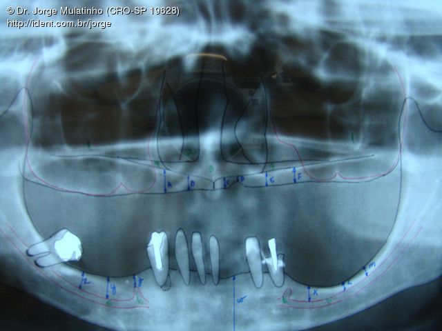 Protocolo com Função Imediata Utilizando Implantes de Corpo Único, Caso ...