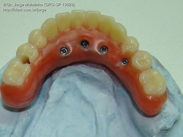 Protocolo com Função Imediata Utilizando Implantes de Corpo Único, Caso ...