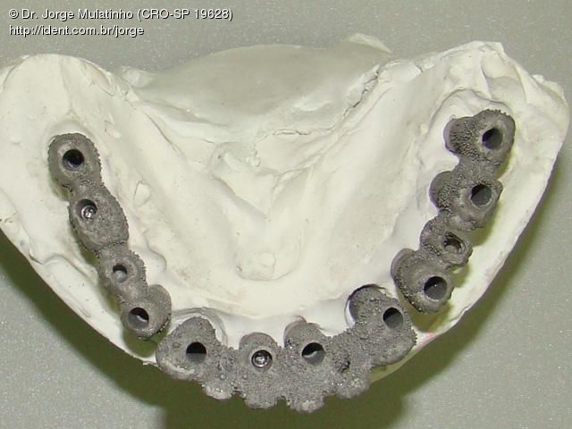 Utilizacao de Implantes de Corpo Unico, Caso clínico | iDent