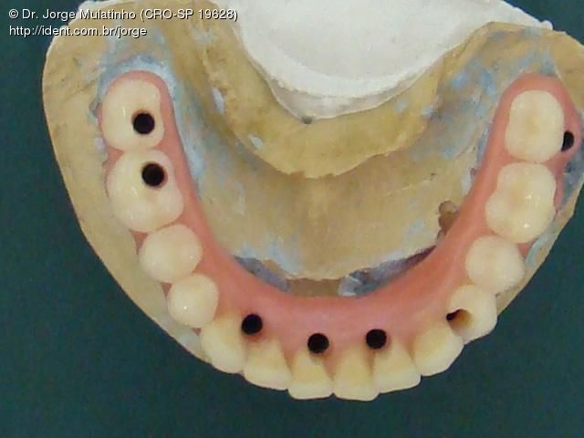 Utilizacao de Implantes de Corpo Unico, Caso clínico | iDent