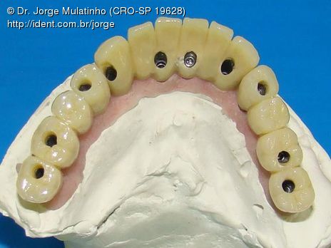 Utilizacao de Implantes de Corpo Unico, Caso clínico | iDent