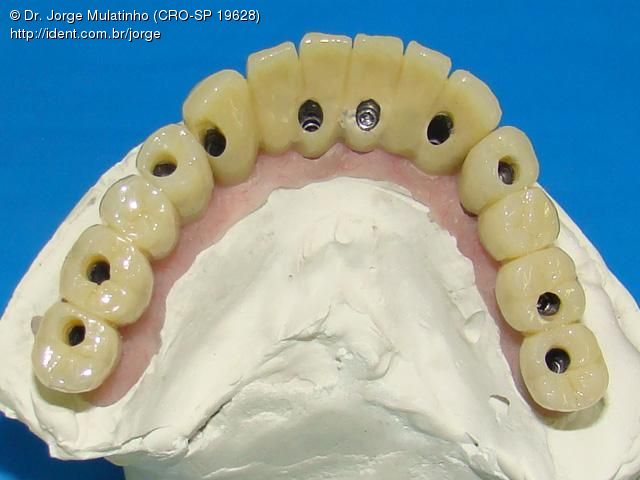 Utilizacao de Implantes de Corpo Unico, Caso clínico | iDent