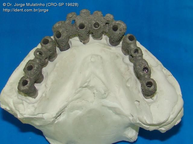 Utilizacao de Implantes de Corpo Unico, Caso clínico | iDent