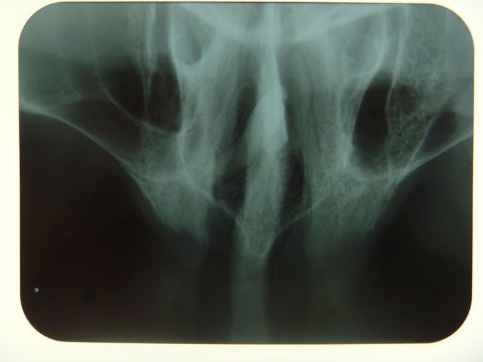 Extração de Dente Supranumerário em Região de Rafe Palatina., Caso ...