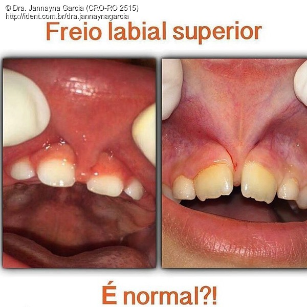 Freio Labial Superior, Caso clínico | iDent