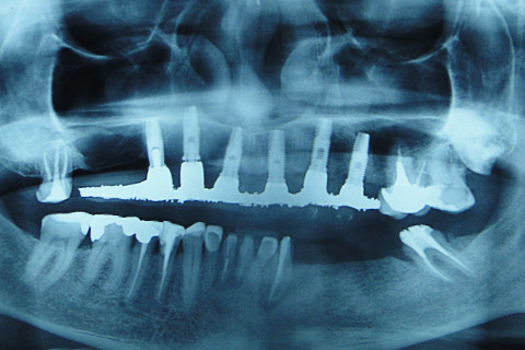 Solução Alternativa para Protocolo Superior com Flange Extensa ( com ...