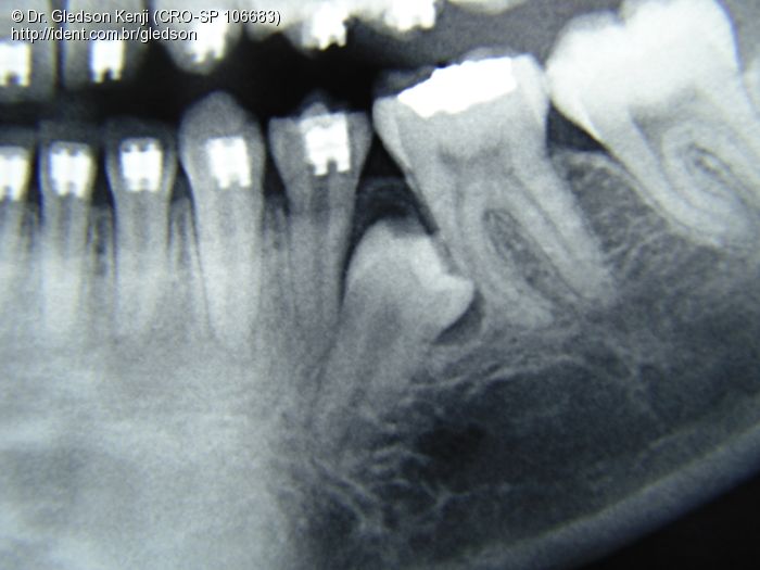 Exodontia Pré-Molar Incluso -Dente 35, Caso clínico | iDent
