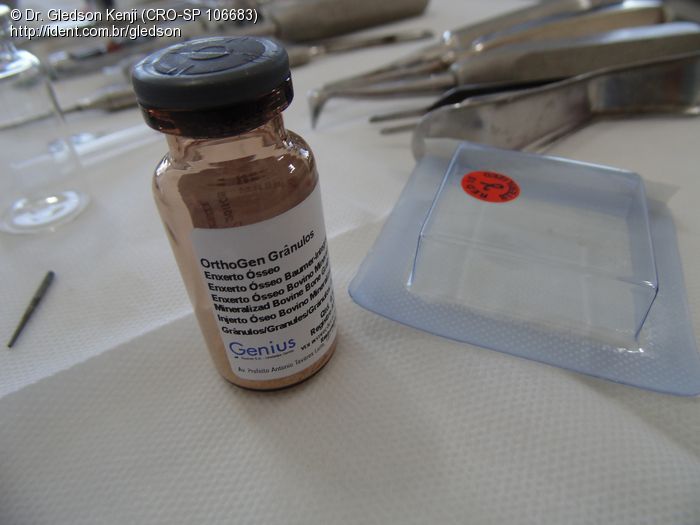 Exodontia Pré-Molar Incluso -Dente 35, Caso clínico | iDent