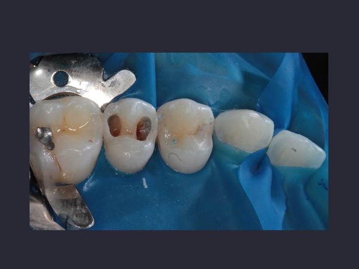 Passo a Passo Resina Composta Direta, Caso clínico | iDent