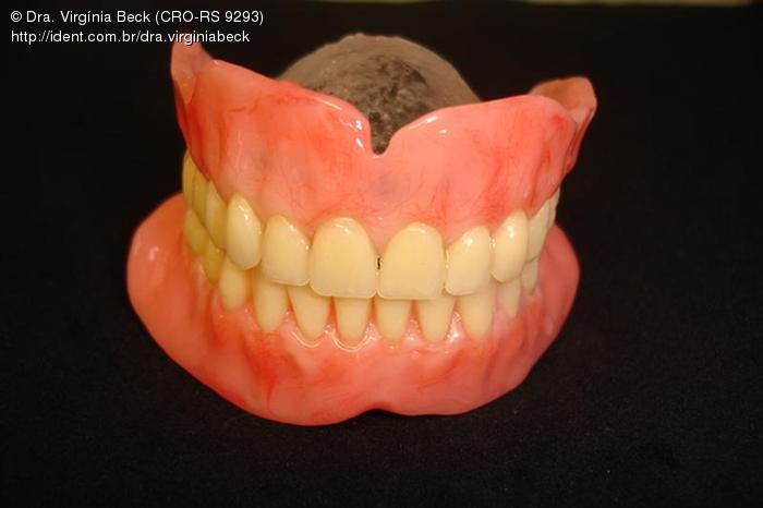 Overdenture Sobre Implantes com Attachment Magnético, Caso clínico | iDent