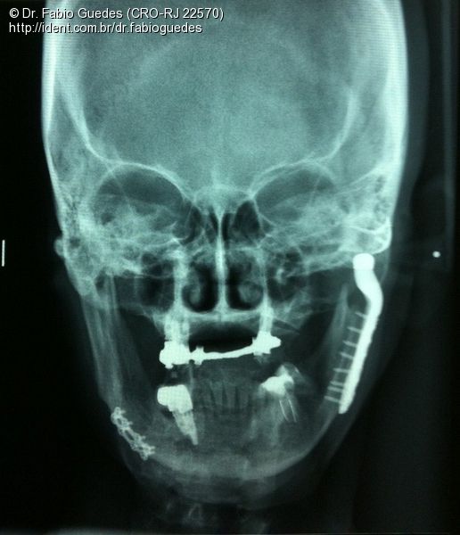 Artroplastia Total de Atm com Protocolo Superior, Caso clínico | iDent Artroplastia Total de Atm com Protocolo Superior, Caso clínico | iDent