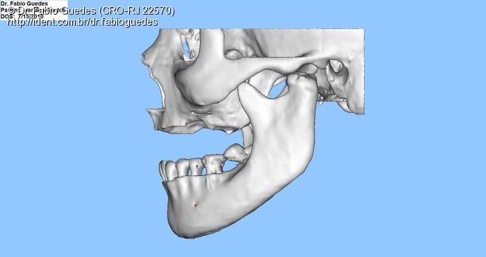 Artroplastia Total de Atm com Protocolo Superior, Caso clínico | iDent Artroplastia Total de Atm com Protocolo Superior, Caso clínico | iDent