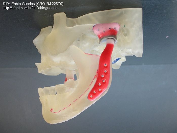 Artroplastia Total de Atm com Protocolo Superior, Caso clínico | iDent Artroplastia Total de Atm com Protocolo Superior, Caso clínico | iDent