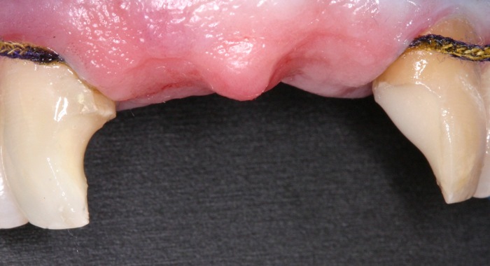 Prótese Adesiva em Resina Composta Reforçada por Fibra de Vidro: Uma ...