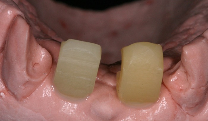 Prótese Adesiva em Resina Composta Reforçada por Fibra de Vidro: Uma ...