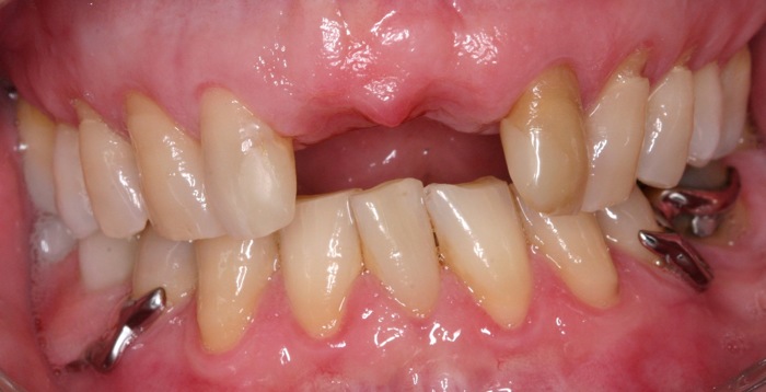 Prótese Adesiva em Resina Composta Reforçada por Fibra de Vidro: Uma ...