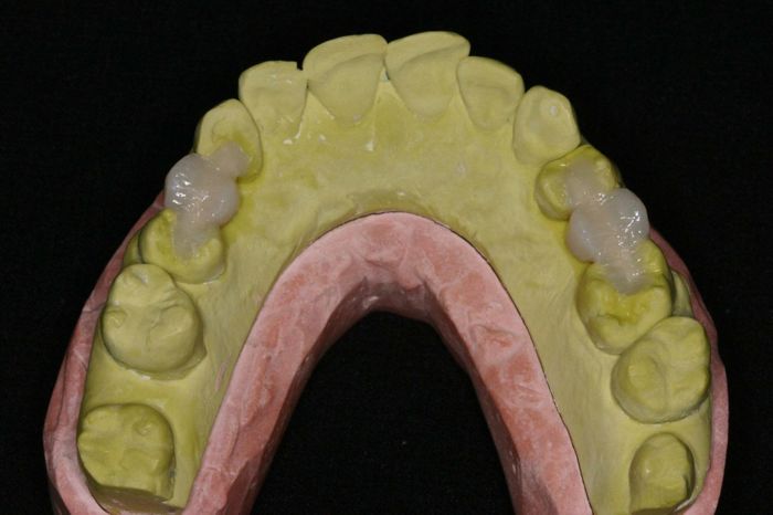 Prótese Parcial Fixa Adesiva em Resina Composta com Reforço de Fibra de ...