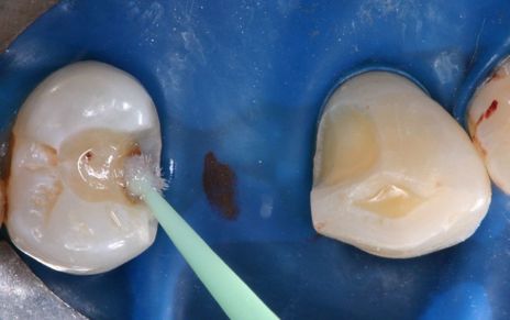 Prótese Parcial Fixa Adesiva em Resina Composta com Reforço de Fibra de ...