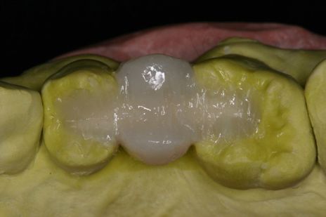 Prótese Parcial Fixa Adesiva em Resina Composta com Reforço de Fibra de ...