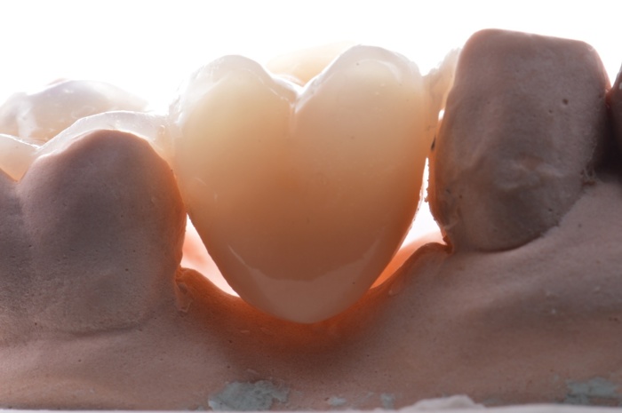 Protocolo de Confecção de Prótese Adesiva em Resina Composta Reforçada ...