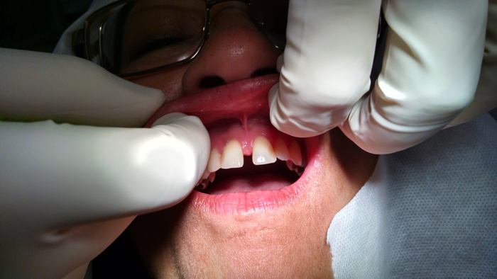 Frenectomia Labial Superior, Caso clínico | iDent