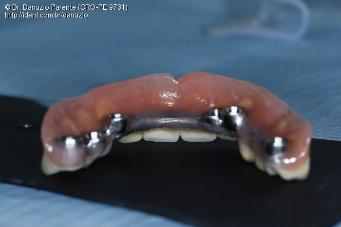 Protocolo Superior e Inferior em Carga Imediata., Caso clínico | iDent